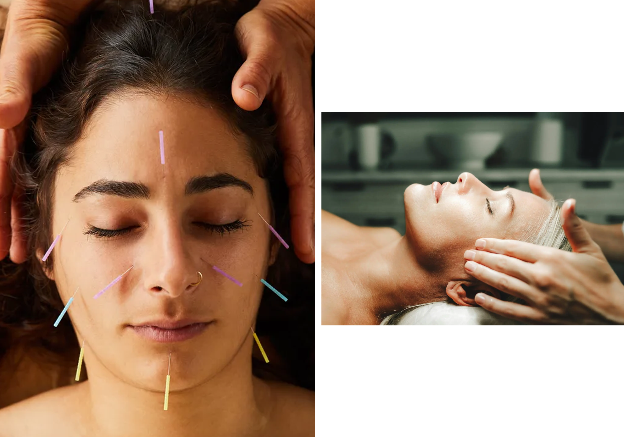 The Needle’s Edge: Why Facial Acupuncture is NYC’s Premier “Notox ...